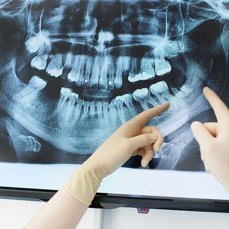 Tooth Extractions Caldwell & Florham Park | Surgical Tooth Removal | NJ ...